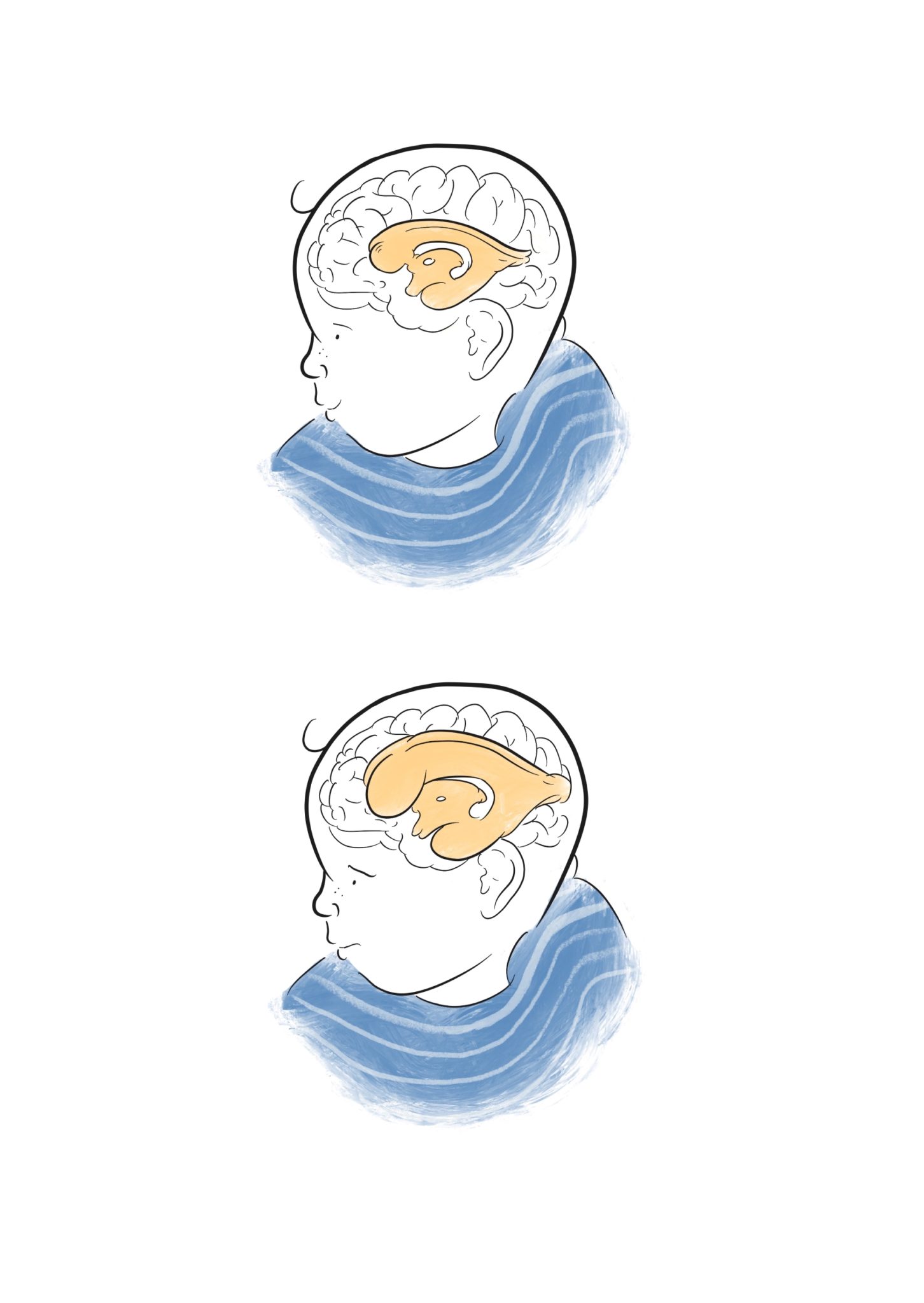 Hydrocephalus | Brainbook