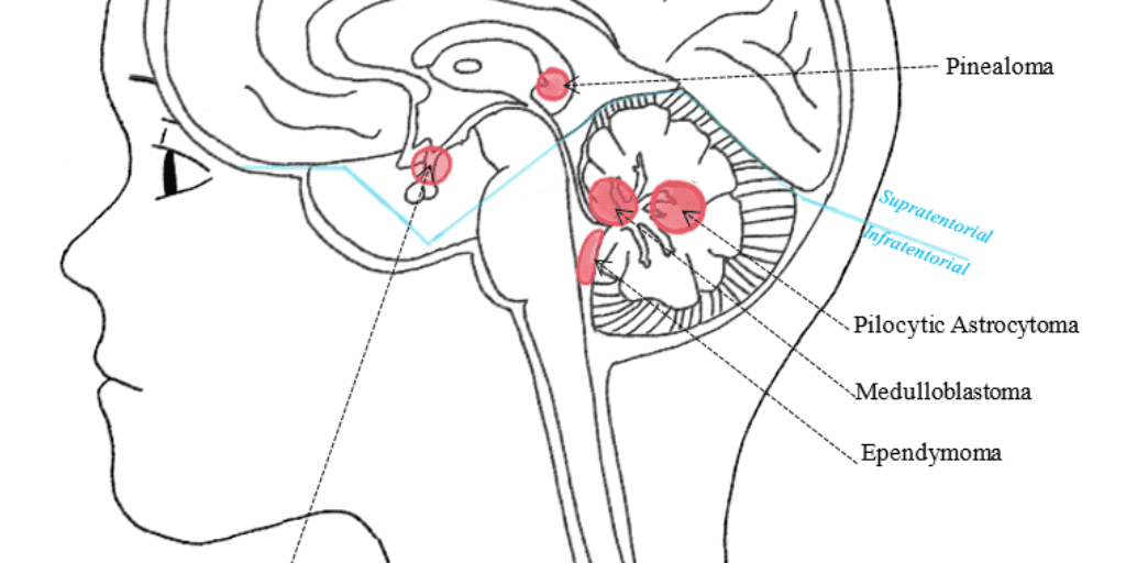 Pediatric Primary Brain Tumors | Brainbook