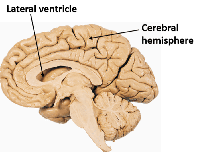 Cranial Cysts | Brainbook
